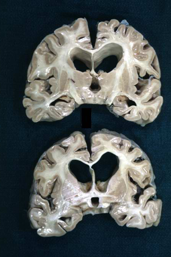 Image 5: Cerebrocortical atrophy (Alzheimer's disease)